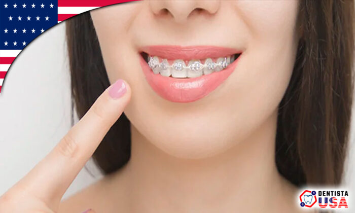 Exciting Precio De Brackets En Estados Unidos Images