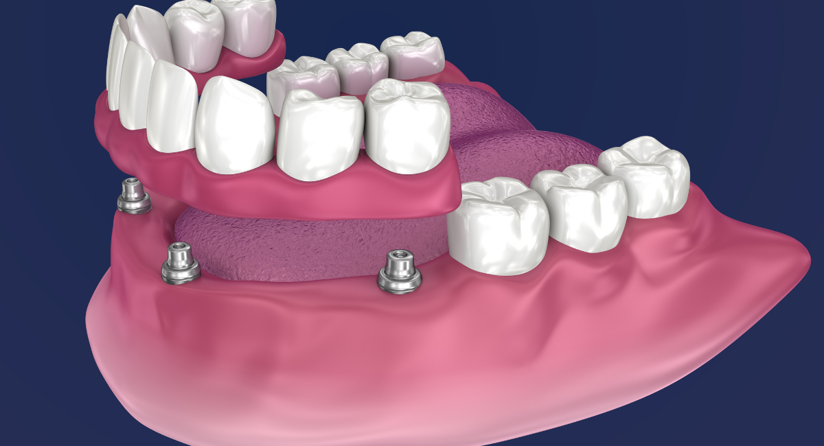 Dentadura postiza fija en 4 implantes