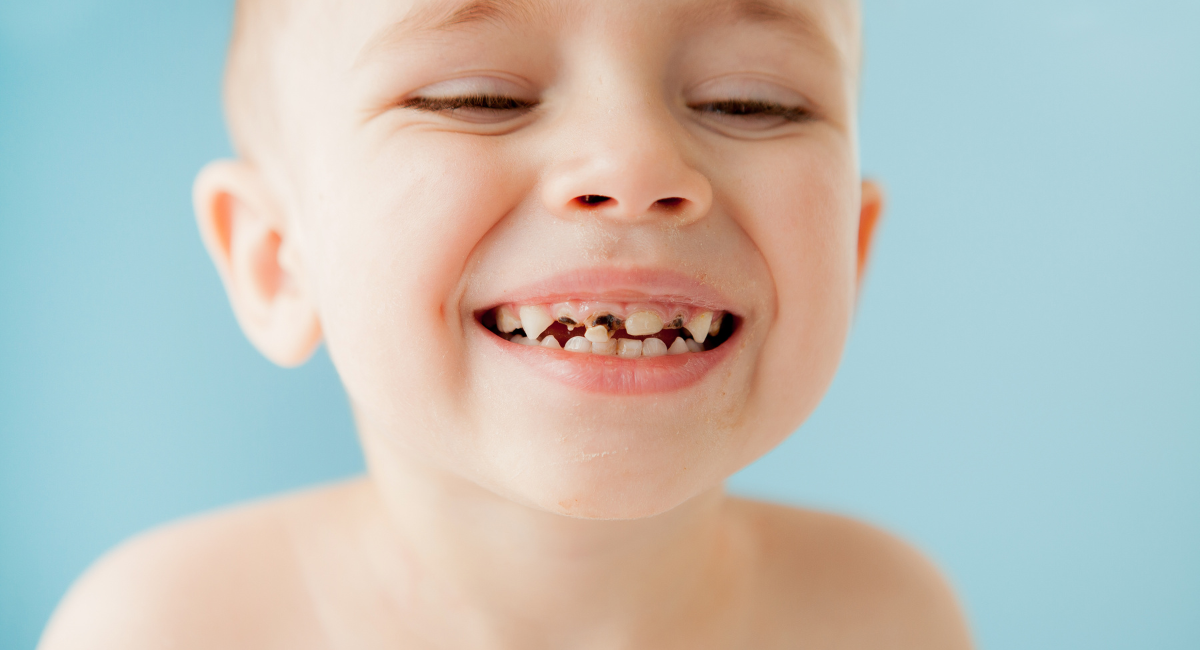 Dientes de niños podridos - ¿Cuando acudir al dentista pedatrico?