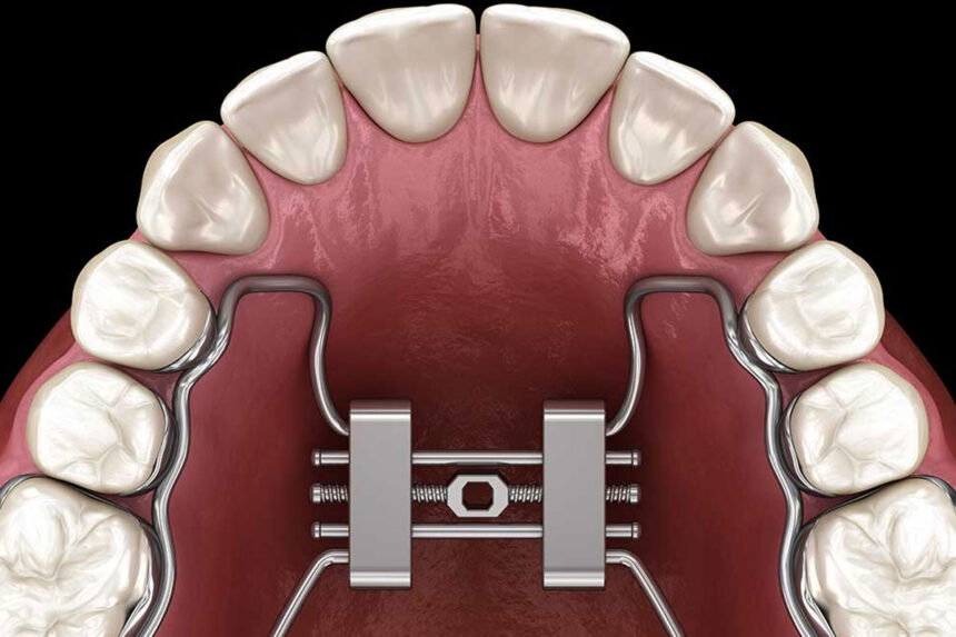 Expansor dental infantil: Precios, y beneficios